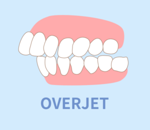 Underbite vs. Overbite: What’s the Difference and How are They Treated ...